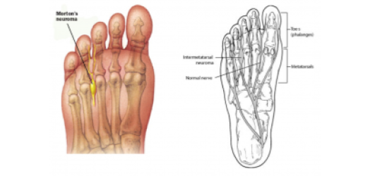 Morton's Neuroma (intermetatarsal neuroma) - San Mateo Podiatry Group